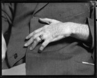 Scar on hand of murder suspect Arthur C. Burch, Los Angeles, 1922 ...