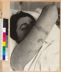 Morgue photograph of Virginia Rappe showing bruises on arm — Calisphere