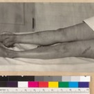 Virginia Rappe's face, probably at morgue — Calisphere