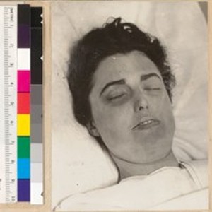 Virginia Rappe's face, probably at morgue — Calisphere