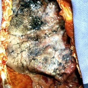 Illustration of left hemipelvis and hip joint, anterior view, showing ...