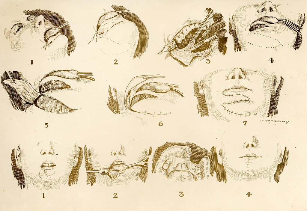 Diagram of facial surgery [1] — Calisphere
